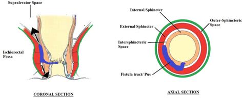 Schematic Diagram Highlighting Abscessfistula Tract In The