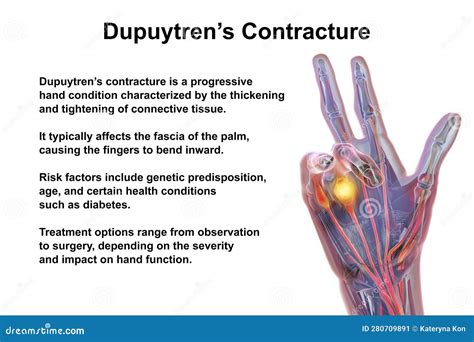 Dupuytren`s Contracture Dupuytren`s Disease In Left Hand Vector Illustration Cartoondealer