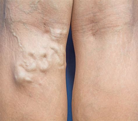 3 Reasons To Treat Your Swollen Veins Now Mimit Health Mimit Health