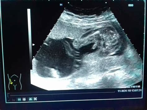 Turtle Sign Xy Male Gender Ultrasound Guided Tips