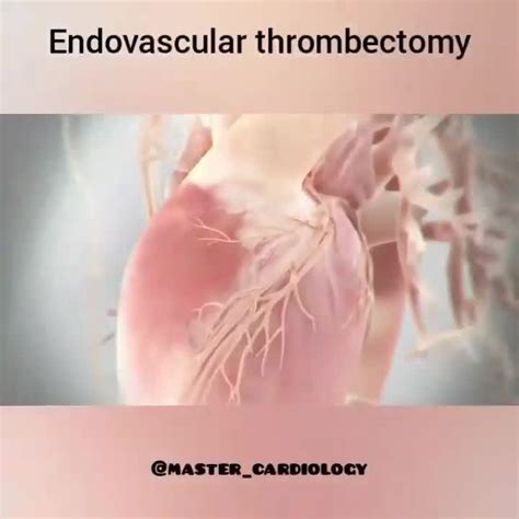 Karri Martone Cpc Ccc Ccvtc On Linkedin Cardiodork