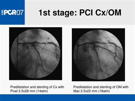 PPT Multivessel PCI Procedure Complicated With Fracture Of The Wire PowerPoint Presentation