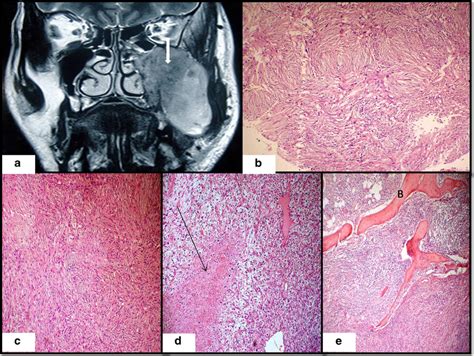 A Mri Of Paranasal Sinuses A Large Mass In The Left Maxillary Sinus