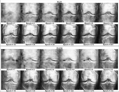 Deepfake Knee Osteoarthritis X Rays From Generative Adversarial Neural Networks Deceive Medical