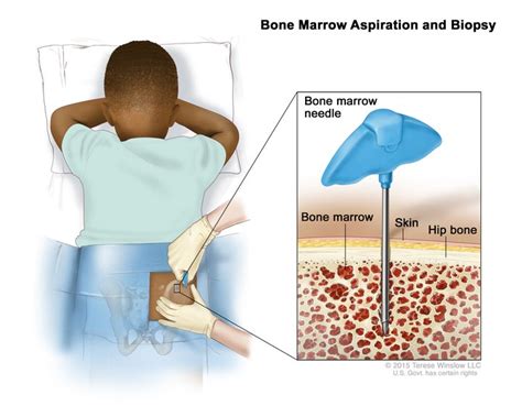Bone Marrow Biopsy Sample