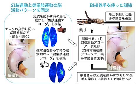 ―失われた手の痛みをなぜ感じるのか？―念じると動く義手で幻肢痛のコントロールに成功 国立研究開発法人日本医療研究開発機構