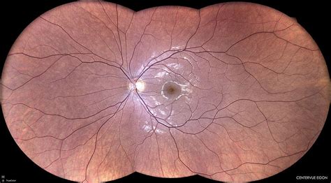 Fundus Photography Retina Center Of San Diego