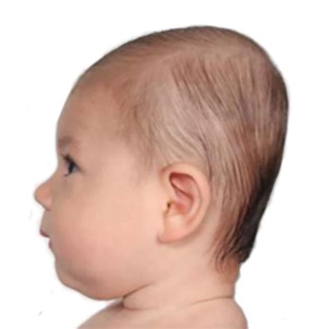 Flat Head Syndrome The Rockaway Times