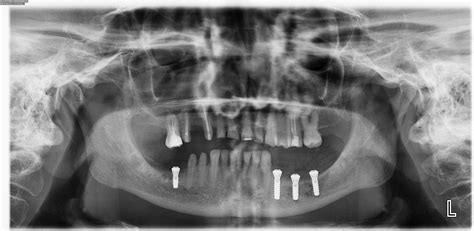 Implant Object Detection Dataset By Implantdeneme