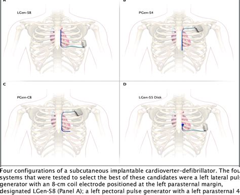 Four Configurations Of A Subcutaneous Implantable Download