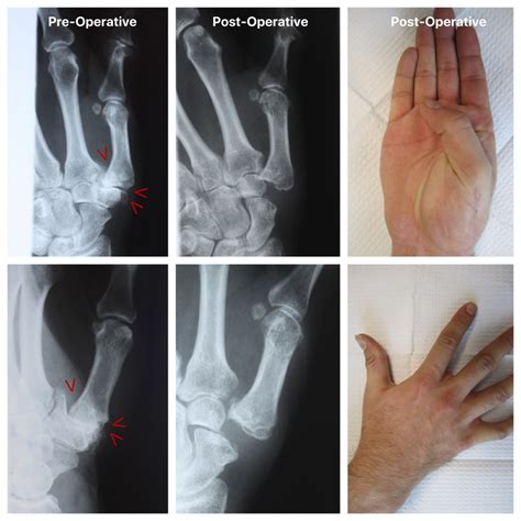Thumb Cmc Arthroplasty 2 John Erickson Md