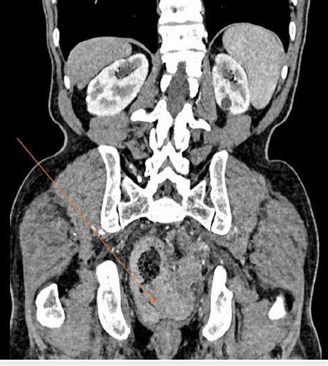Coronal Section Of Contrast Ct Scan Of The Abdomen The Arrow Denotes