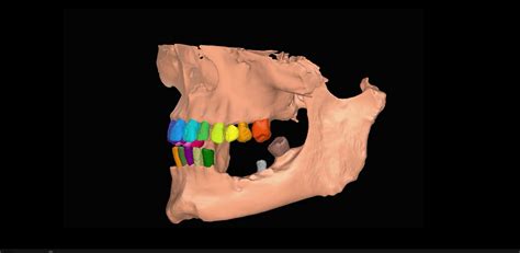 Segmentation Extracting Segments Surgical Guides And Implantation Planning Software Free