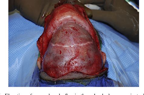 Figure 6 From The Coronal Scalp Flap Surgical Technique Semantic
