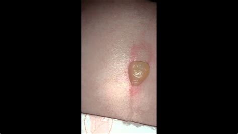 Burn Blister Popped Care At Patricia Flores Blog