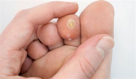 Corn Vs Wart On Foot How To Tell The Difference And Get Treatment