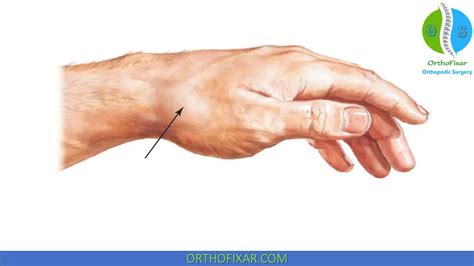 Scaphoid Fracture Classification