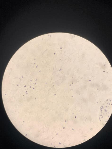 A Giant Fibroepithelial Polyp Of The Vulva PMC