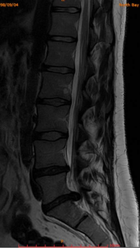 Finally Got An Mri Rsciatica