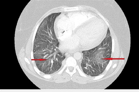 Ct Angiogram Of Chest Showing Patchy Ground Glass Opacities At