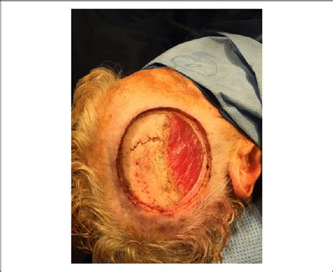 Preoperative Scalp Sarcoma Expander Previously Removed Due To