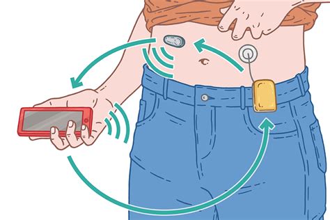 How Does An Artificial Pancreas Work Marie Ducom Science Illustrator