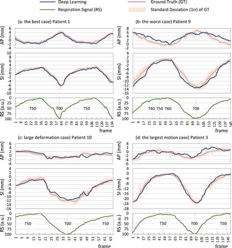 Explainability And Controllability Of Patient‐specific Deep Learning