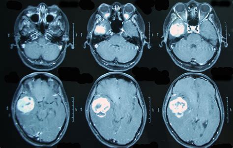 Differentials Craniectomy With Excision Of Tumor Mass