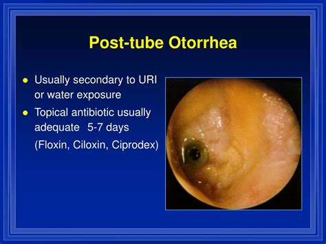 Ppt Otitis Media And Eustachian Tube Dysfunction Powerpoint