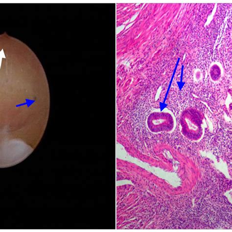 Hysteroscopy Visualized A Normal Uterine Cavity White Arrows And