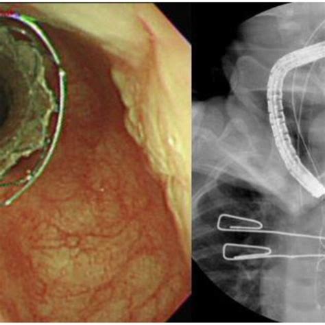 Placement Of A Biliary Stent In The Esophagus Under Endoscopic And