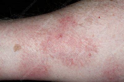 Skin In Mycosis Fungoides Stock Image C0111786 Science Photo Library