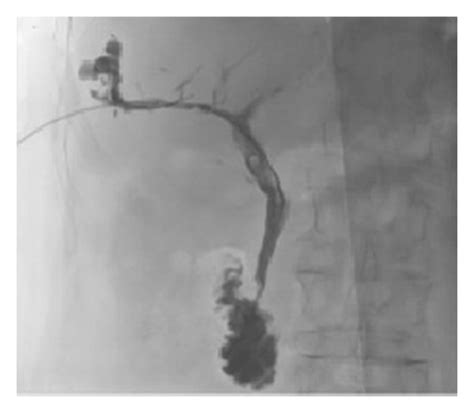 Percutaneous Cholangiography A And Chest Abdomen Ct Scan B C