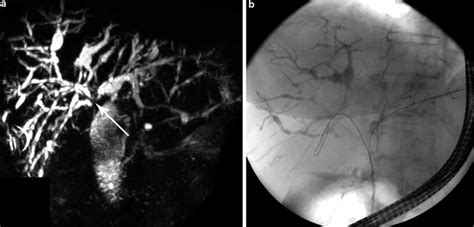 Of Hilar Cholangiocarcinoma For Liver Transplantation Radiology Key