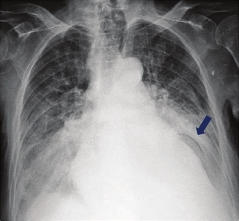 Follow Up Chest Radiograph Showing Gastric Pneumatosis As A Linear Download Scientific Diagram