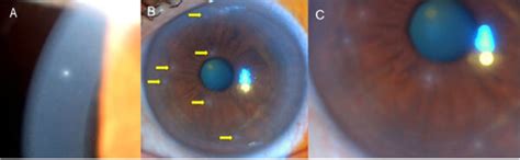 A A Typical Corneal Lesion Of Punctate Keratopathy Of West Indians
