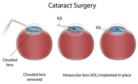Extracapsular Cataract Extraction Techniques Uses And Benefits