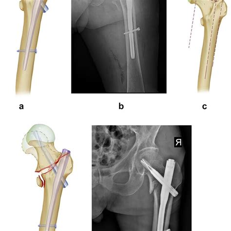 Wedge And Reverse Wedge Effect Wedge Effect Is Specified As Femoral Download Scientific