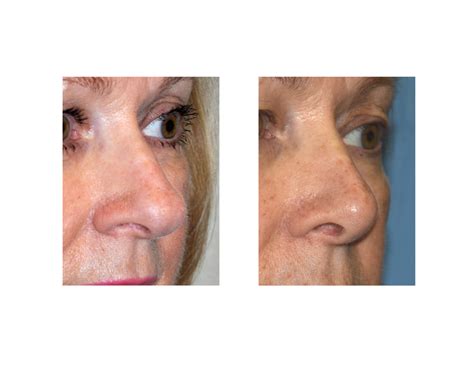 Case Study Rhinoplasty For The Aging Overprojected Nose Explore