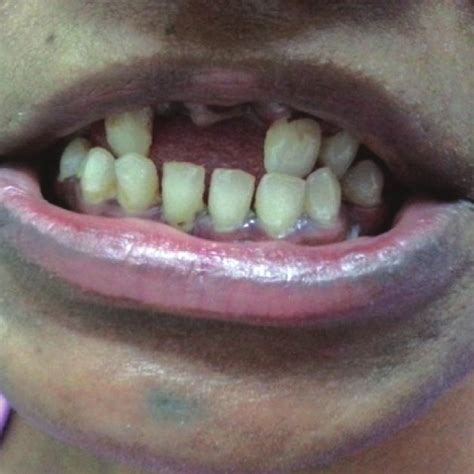 Hyperkeratosis Hypergranulosis Acanthosis With Regular Elongation Of