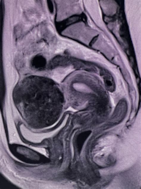 Fibroid Position Make A Difference Rfibroids