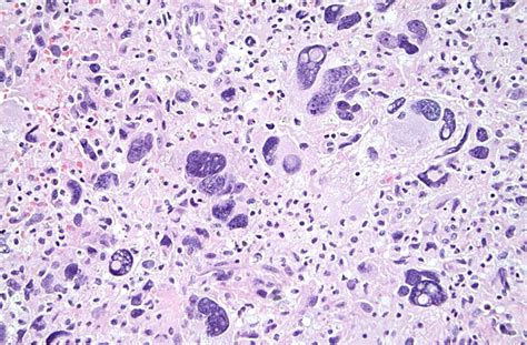 Undifferentiated Pleomorphic Sarcoma Mypathologyreport Ca