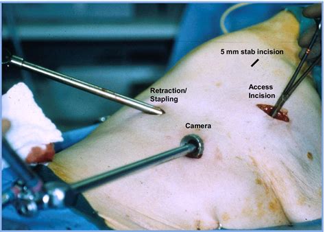 Thoracoscopic Basilar Segmentectomy Seminars In Thoracic And