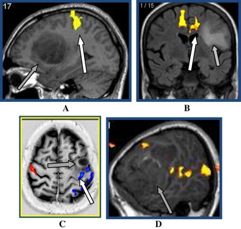 Different Relations Between The Eloquent Brain Areas And The Brain Download Scientific Diagram
