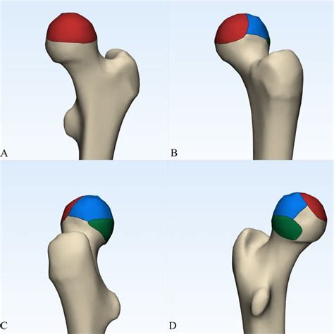 Ficat And Arlet Classification 32 Modified For Osteonecrosis