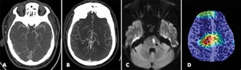 deep learning enables rapid detection of stroke causing blockages