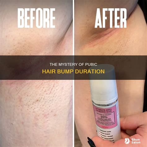 The Mystery Of Pubic Hair Bump Duration Shunsalon