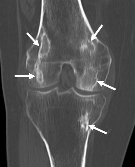 Knee Subchondral Stress Fracture