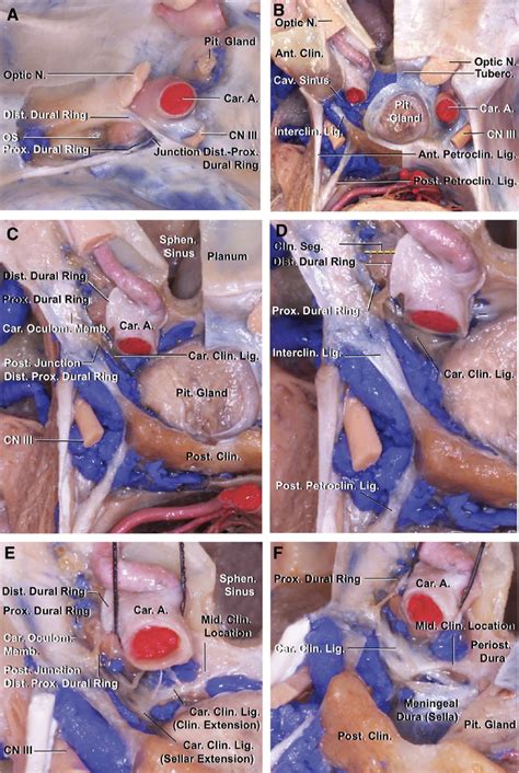 Dural Relationships And Ligaments In The Cavernous Sinus Endocranial