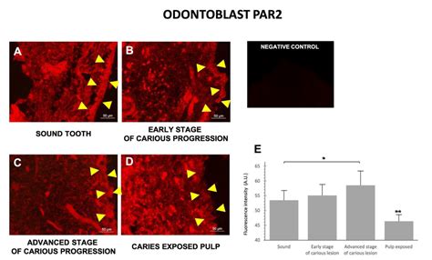 Expression Of Par2 And Nf κb In Human Primary Dental Pulp Odontoblasts